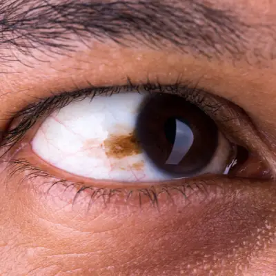 Eye tumors Moorfields Eye Hospitals UAE